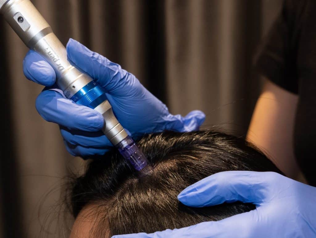 Guide to Microneedling for Hair loss: How to Make it Work - TrichoLab