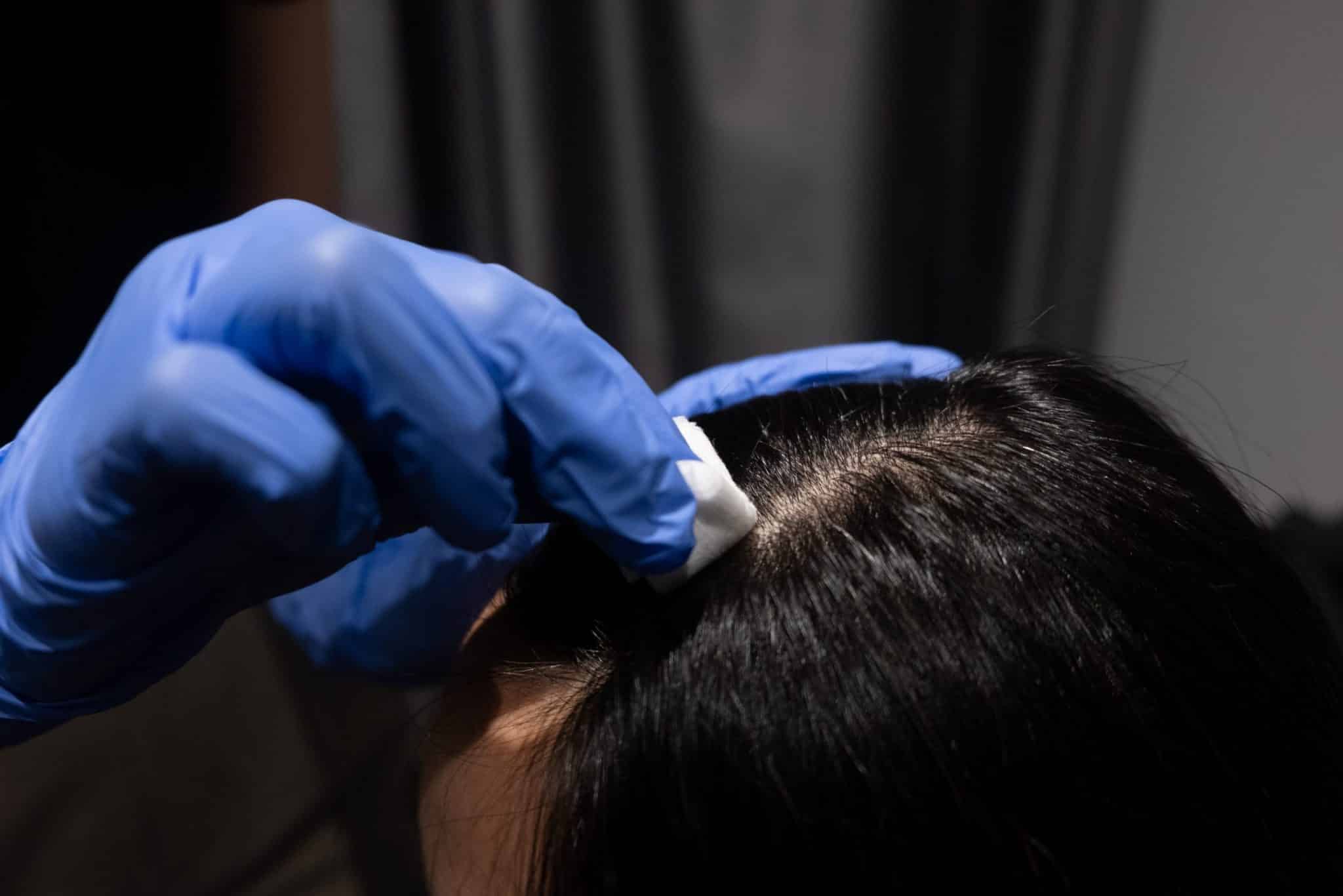 Salicylic Acids Peel - TrichoLab