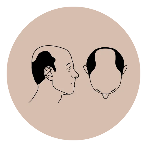 Male vs Female Hair Loss: Differences & Treatment Options