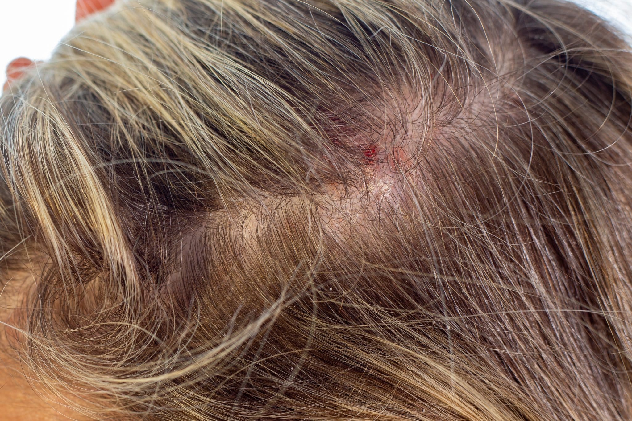 How to manage scalp eczema during a flare-up