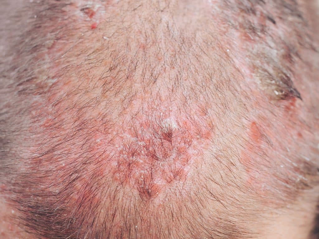 Scalp pimples: Causes and treatment