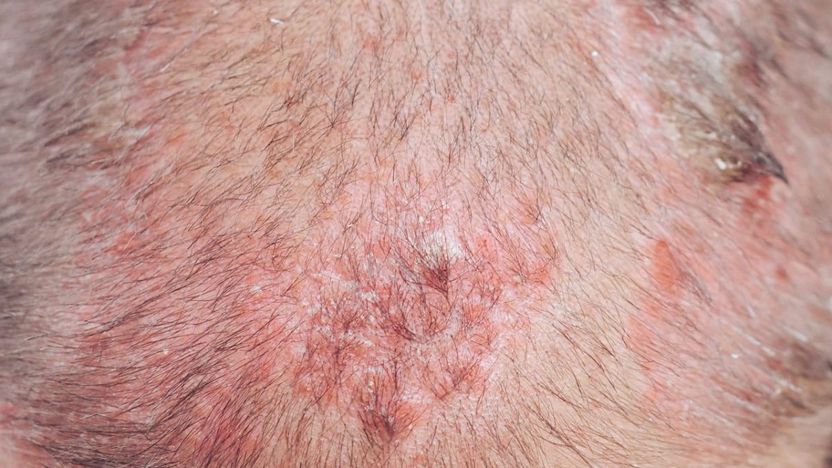 Folliculitis On Scalp Folliculitis: Diagnosis And Management Of