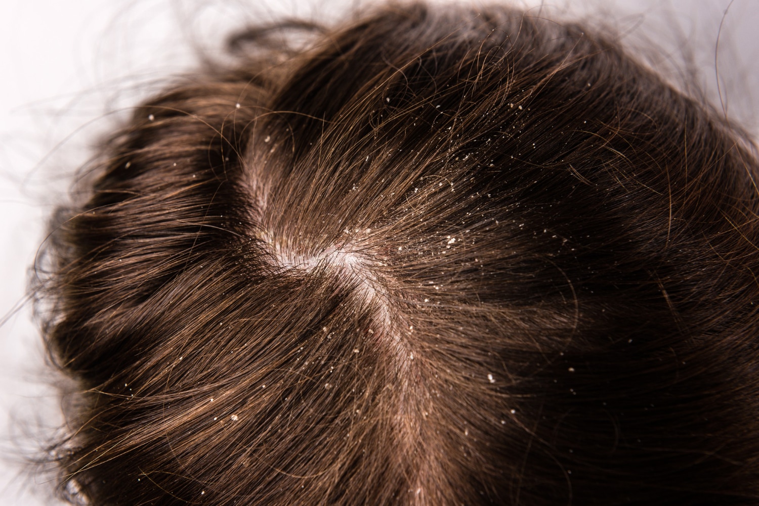 Demodex Scalp Treatment in Singapore | TrichoLab